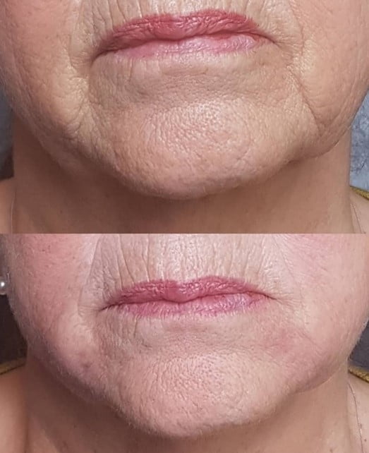 Lip and Dermal Fillers | North Yorkshire Dentist | Dentist Leyburn